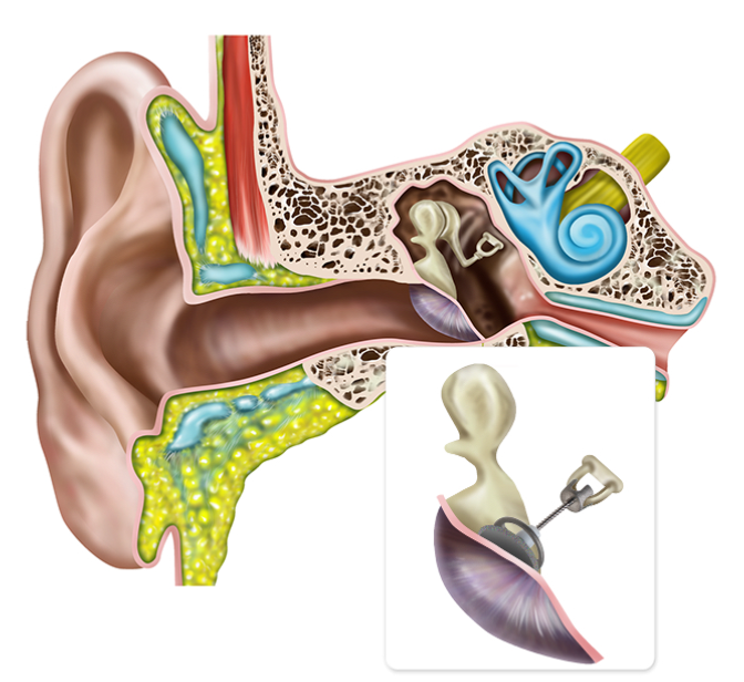 Gehoorbeenketen – dr. Crins, NKO-arts / Otoloog